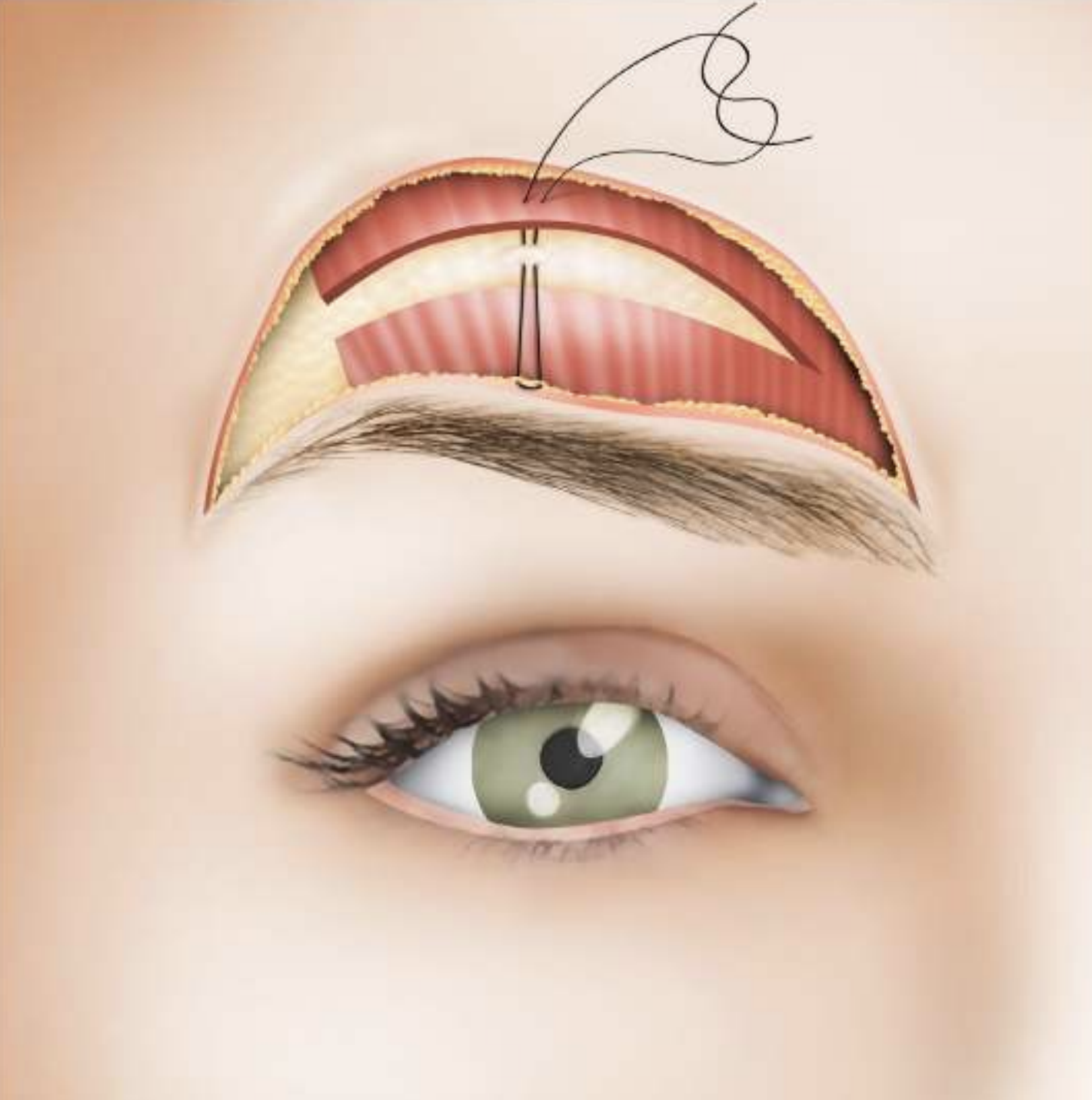 Lifting sourcils - Dr. Sidhoum - Chirurgien Esthétique Rennes